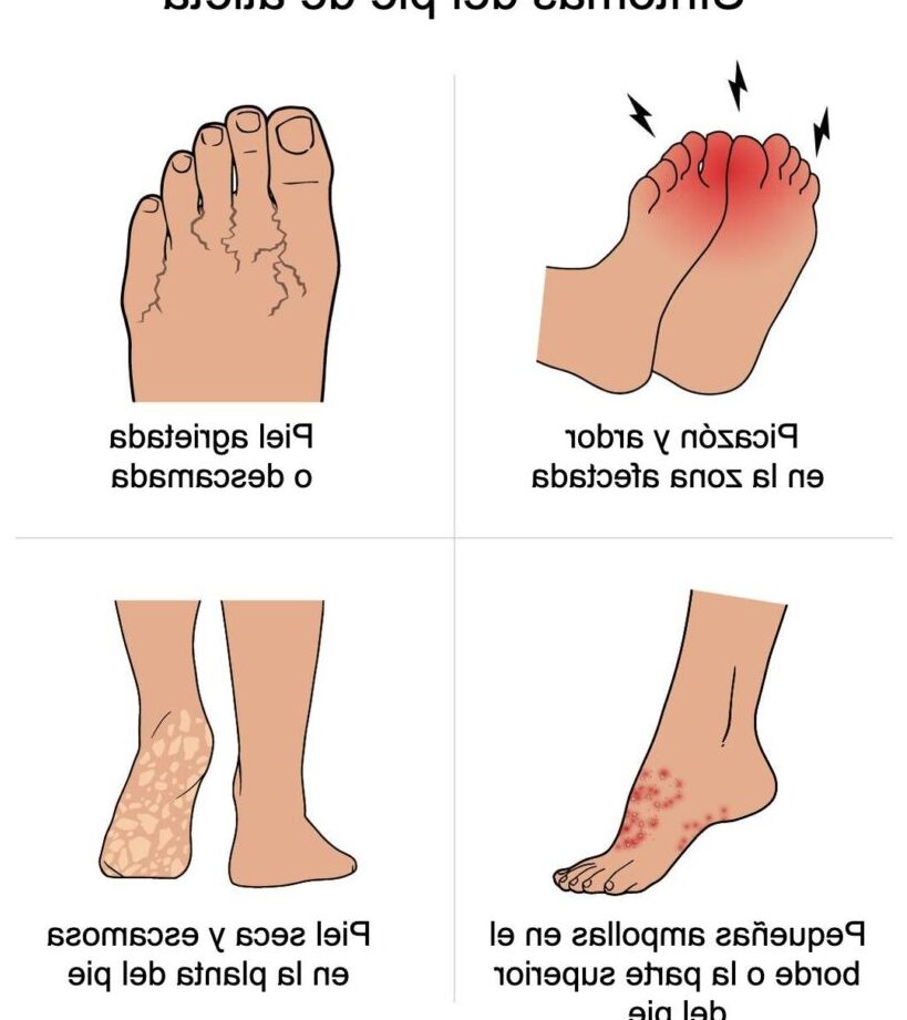 ¿Cómo identificar los signos de una infección en el pie y qué hacer al ...