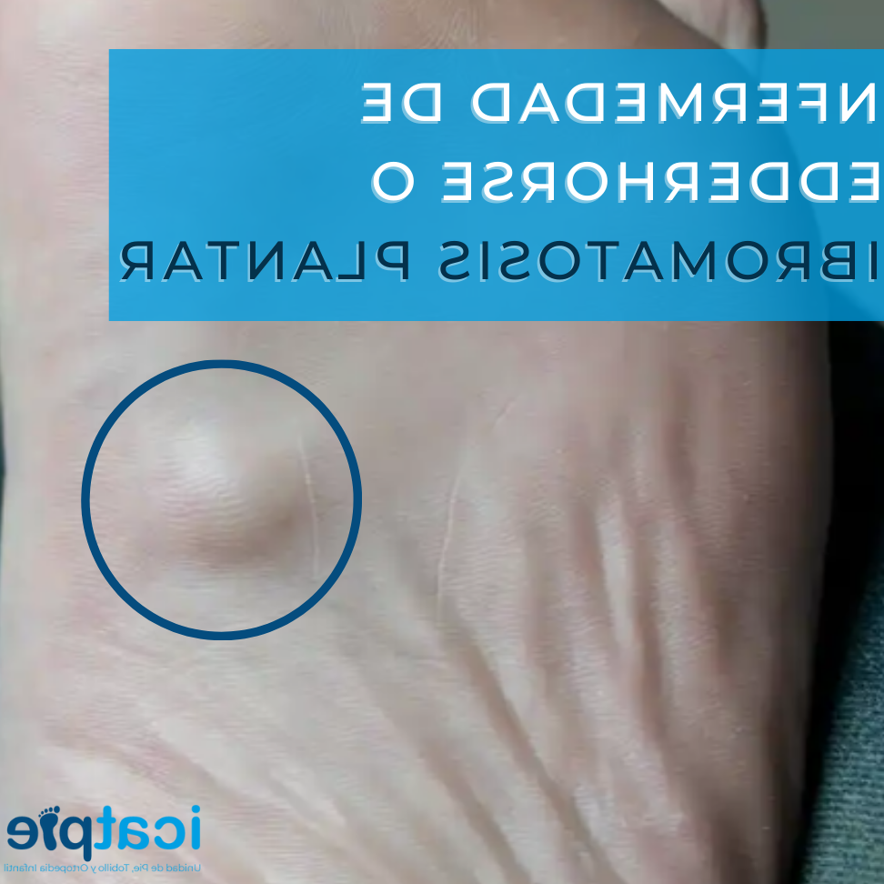 Todo lo que debes saber sobre la fibromatosis plantar: causas, síntomas ...